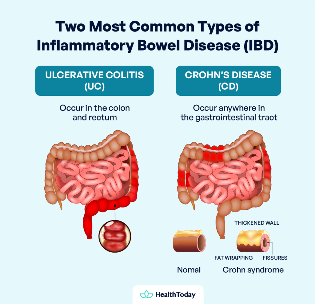 How To Calm Inflamed Intestines? Explore The Causes, Symptoms, and ...